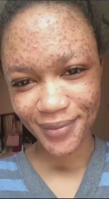 Pharmaderm SOS Zero Acne Facial Antiseptic Cream 1 – Starsam Naturals