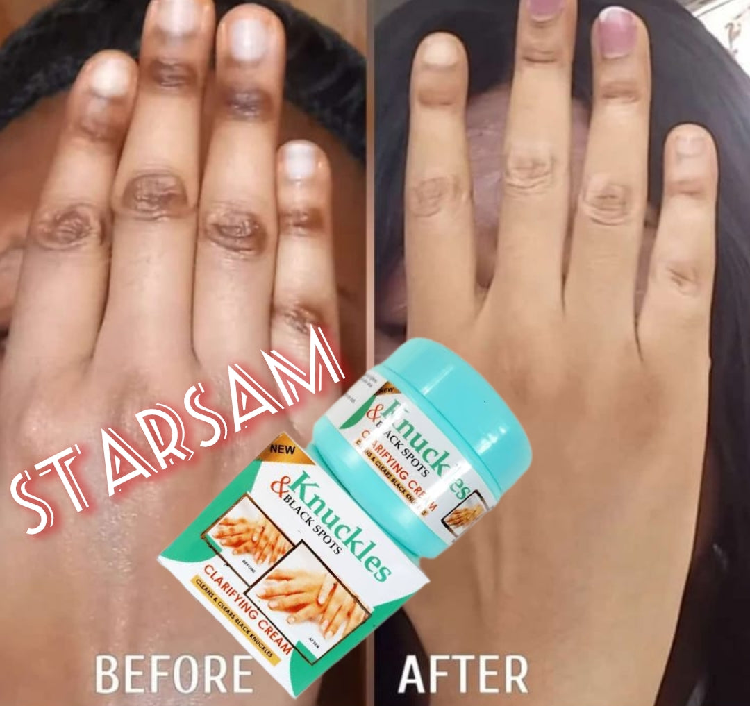 Skin Beauty Knuckles Elbow Knee Toes Black Spot Cream – Starsam Naturals